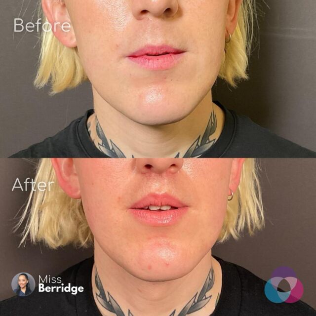 Transgender Before And After Genitalia Female To Male